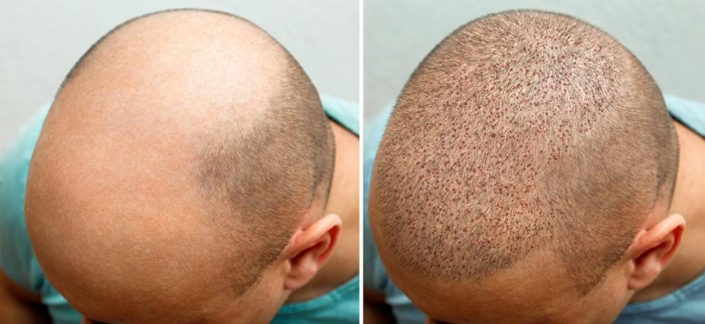 What To Do And What Not To Do After Hair Transplant Procedure
